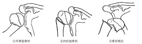 第三节 肱骨近端骨折 中医灾害医学 医学