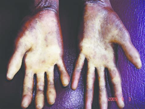 Symmetric Diffuse Yellowish Keratoderma With Scaling And Fissuring Download Scientific