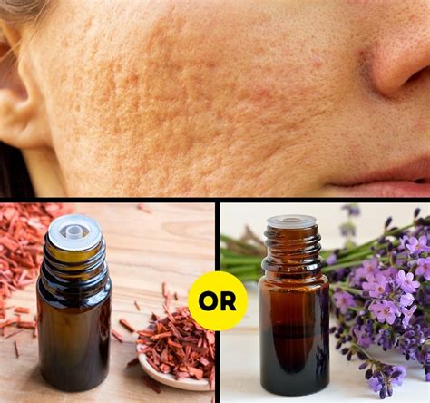 Hacks To Remove All Types Of Scars And Help Them Heal HealthW