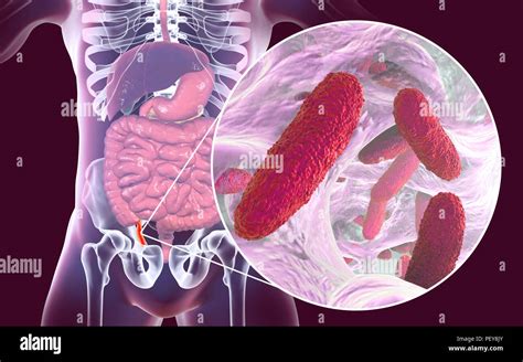 Appendicitis Illustration Of A Human Appendix Showing It Red And Inflamed In Appendicitis And