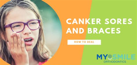 Canker Sores And Braces Mysmile Orthodontics Monroe Ct