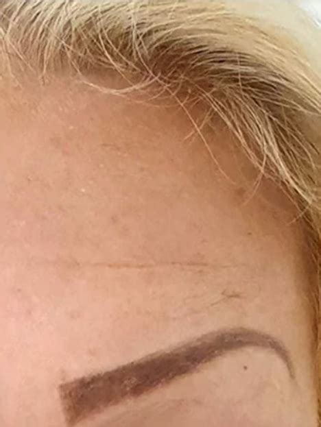 How Long After Botox Can You Lie Down