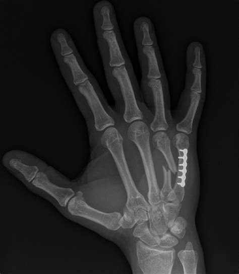 Nx Nail For Fixation Of Displaced 4th Metacarpal Shaft Fracture