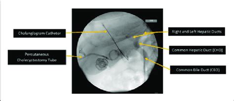 Intraoperative Cholangiogram During Lc Showing Normal Biliary Anatomy
