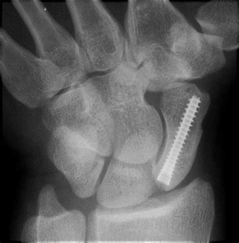 Surgical Treatment Of Scafoid Fracture Centrokinetic