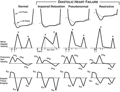 Diastolic Dysfunction