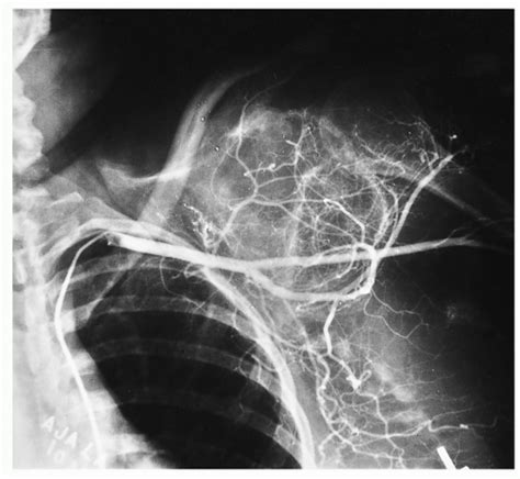 Management Of Neoplasms Of The Shoulder Musculoskeletal Key