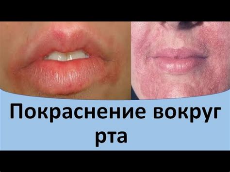 Покраснение вокруг носа и шелушение кожи на лице