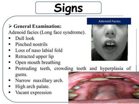 Adenoids Ppt