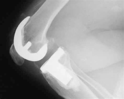 Posterior Subluxation Of Tibia On Stress View Download Scientific