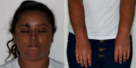 Xeroderma Pigmentosum Treatment