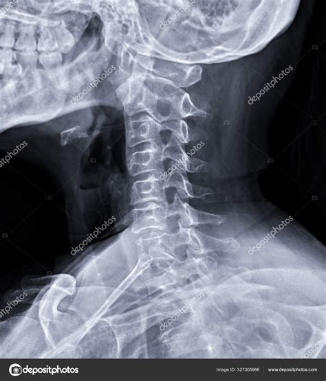 Extension X Ray Cervical Spine Wolfextreme