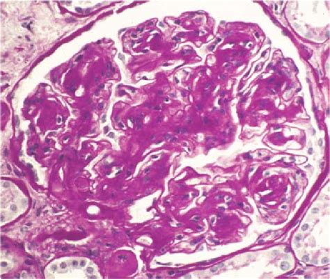 2 Glomerulus From Patient With Diabetic Glomerulosclerosis Showing Download Scientific Diagram