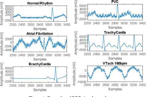 Figure 1 From The Use Of Time Frequency Moments As Inputs Of Lstm Network For Ecg Signal