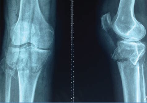 Outcomes In Schatzker Type 5 And Type 6 Tibial Plateau Fractures Treated With Ilizarov External