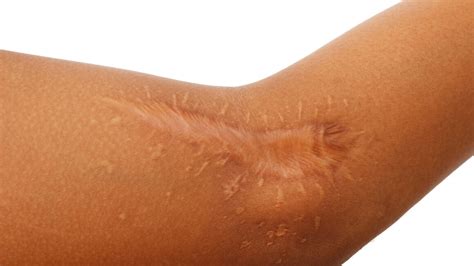 Applications For Scar Tissue Mobilization Graston Technique Llc