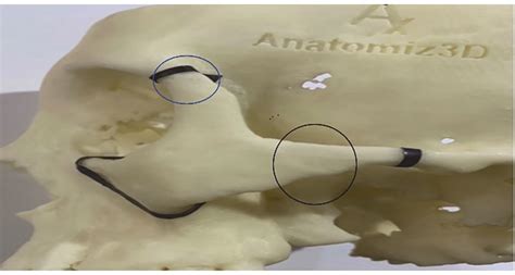 Bone Cuts Are Made On The Lateral Wall Of The Orbit At Fronto Zygomatic