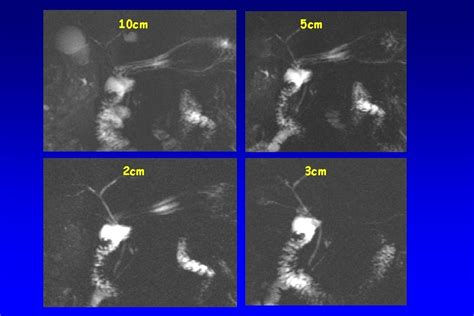 Mrcp Technique And Interpretation 10 Rules In Mrcp