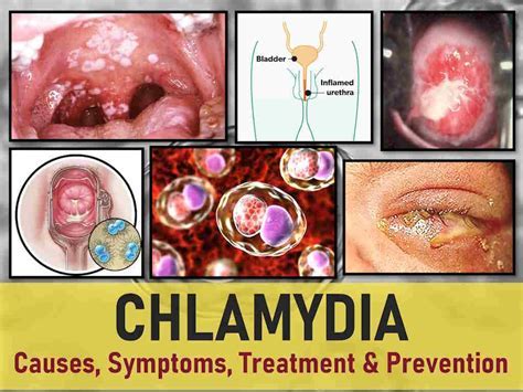 What Does Chlamydia Look Like Nyu Shibboleth