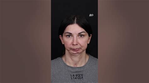 Жила без нижней челюсти Восстановили за одну операцию Youtube