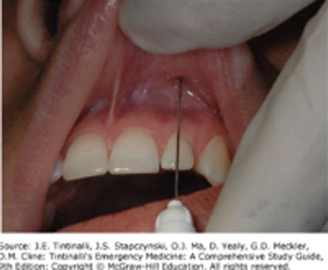 Maxillary Injections Flashcards Quizlet
