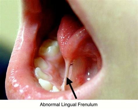 Frenulotomy To Repair Tongue Tie Fort Worth Ent