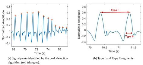 Prediction Of Freezing Of Gait In Parkinsons Disease Using Wearables And Machine Learning