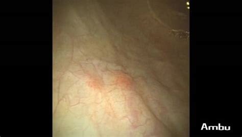 Evaluation And Bladder Neck Assessment With Ascope 5 Cysto Hd Using Advanced Red Contrast Image