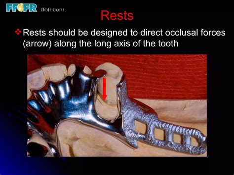 3 Partial Denture Rests Ppt