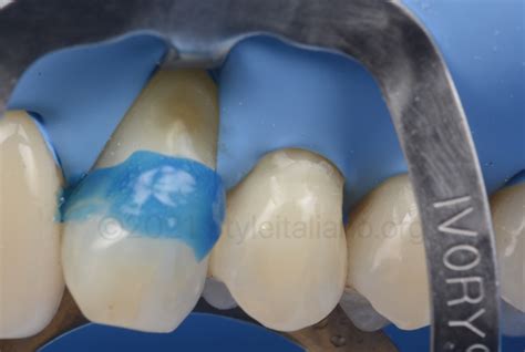 The Closing Gap Technique The Perfect Seal In Class 5 Restorations