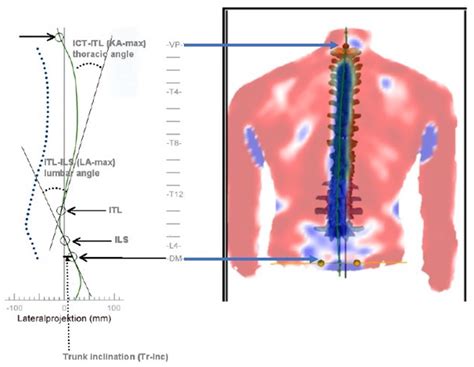 Thoracic Kyphosis Measurement