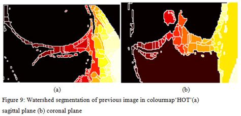 Watershed Algorithm And Adaptive Threshold Canny Edge Detection Based Automatic Segmentation Of