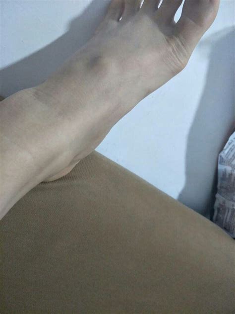 脚背腱鞘囊肿的危害 脚背长了个硬包像骨头 伤感说说吧