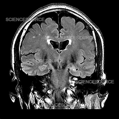 Mesial Temporal Sclerosis Mri Stock Image Science Source Images