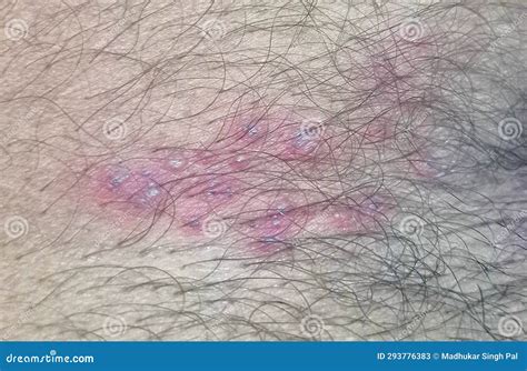 Allergy Rash And Health Problem Close Up Stock Image Image Of