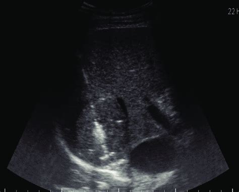 Mw Ablation Probe Placement In The Nodule During Ablation Download Scientific Diagram