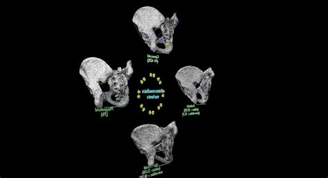 3d File Pelvis Types Hip Bone Labelled Detailed 3d Model 🦴 ・3d Printable Model To Download・cults