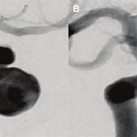 Angiography Findings Before And After Embolization Of The Right Ica Download Scientific