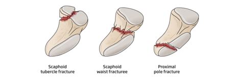 Scaphoideum Fraktur Noms