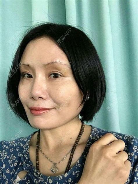 切眉术后图片 切眉图片 大山谷图库