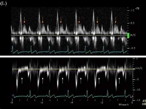 Figure5 Pulsed Doppler Echocardiogram At The Mitral Inflow Upper Download Scientific Diagram