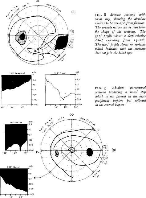 Figure 9 From The Glaucomatous Visual Field Semantic Scholar Figure 9 From The Glaucomatous Visual Field Semantic Scholar