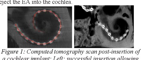 Figure 1 From Smart Electrode Array For Cochlear Implants Semantic Scholar