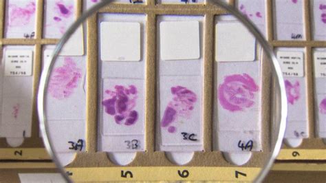 Funds To Develop Ai Cancer Diagnosis In Yorkshire Hospitals Bbc News
