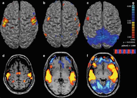 Use Of Fmri Activation Paradigms A Presurgical Tool For Mapping Brain Function Radiology Key