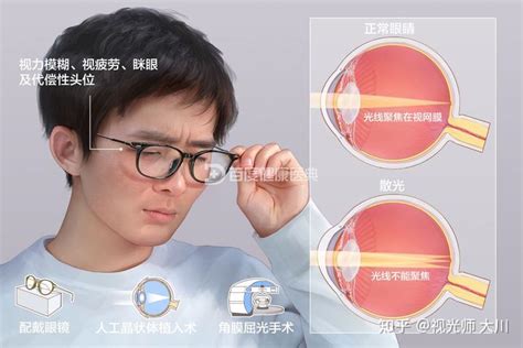 散光是什么 知乎