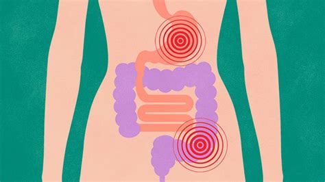 Estrogen Irritable Bowel Syndrome