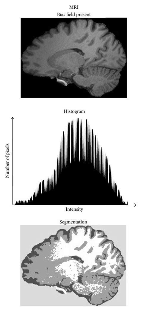 Influence Of The Bias Field On Brain Mri Segmentation A An Example Download Scientific