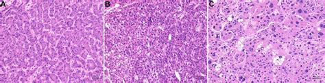 Histopathology Of Hepatocellular Carcinoma When And What