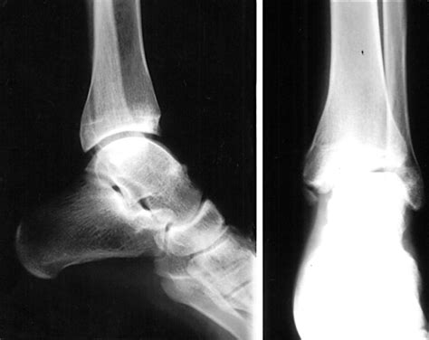 Tibiotalar Joint Dislocation